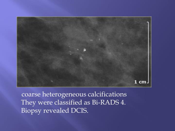 PPT - Breast Calcifications - Differential diagnosis and BIRADS ...