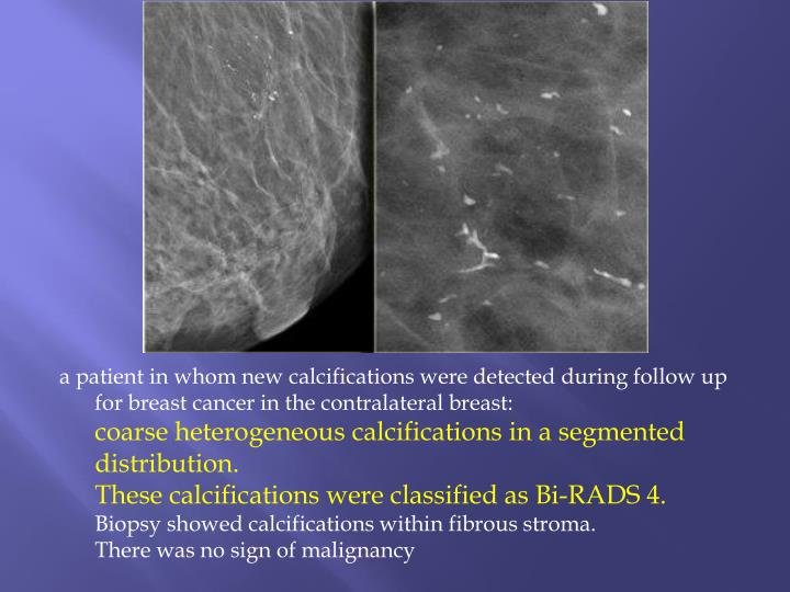 PPT - Breast Calcifications - Differential diagnosis and BIRADS ...