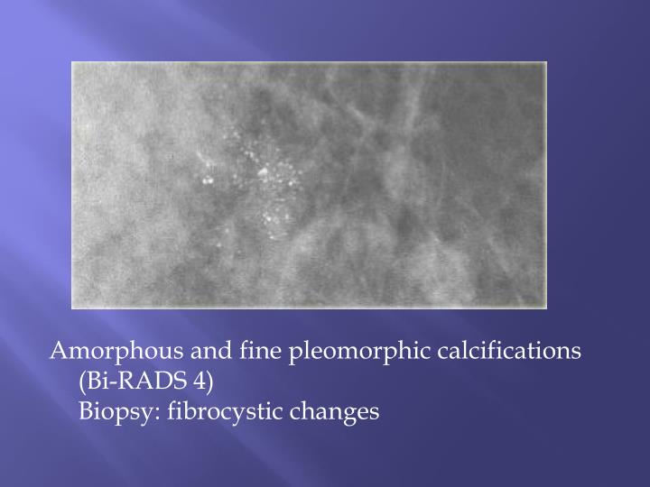 PPT - Breast Calcifications - Differential diagnosis and BIRADS ...