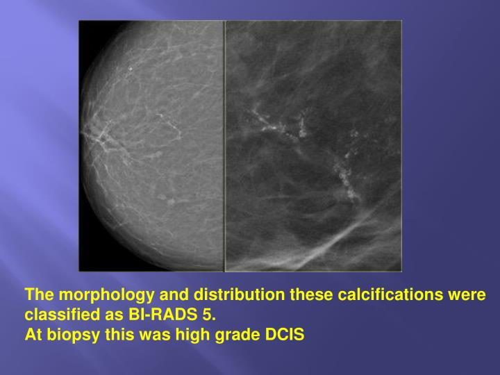 PPT - Breast Calcifications - Differential diagnosis and BIRADS ...