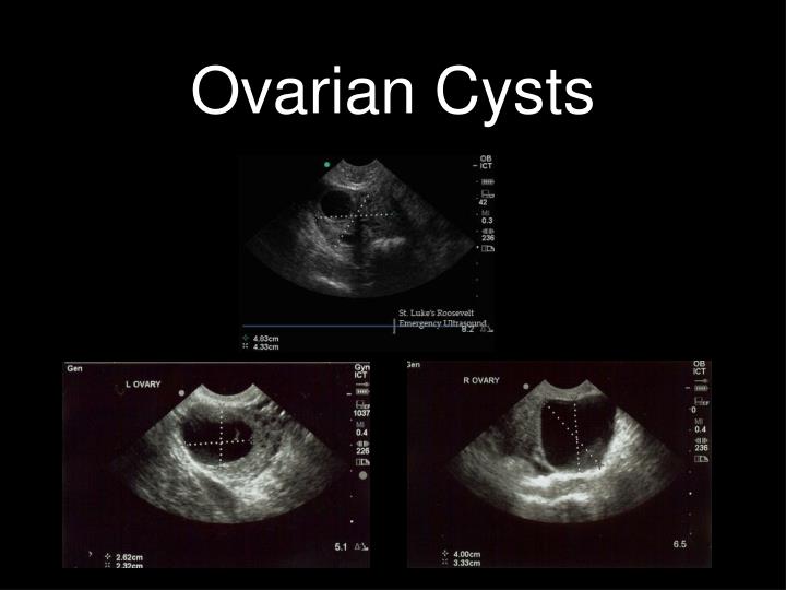 PPT - Ovarian Torsion PowerPoint Presentation - ID:3719107