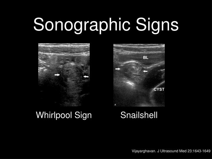PPT - Ovarian Torsion PowerPoint Presentation - ID:3719107