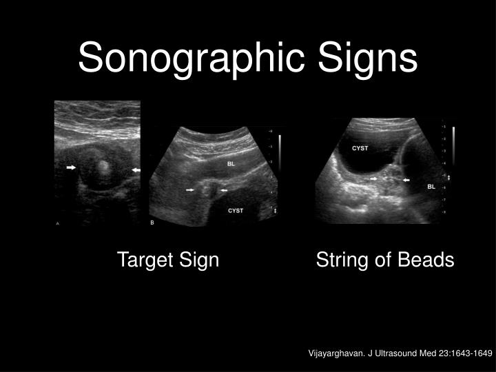PPT - Ovarian Torsion PowerPoint Presentation - ID:3719107