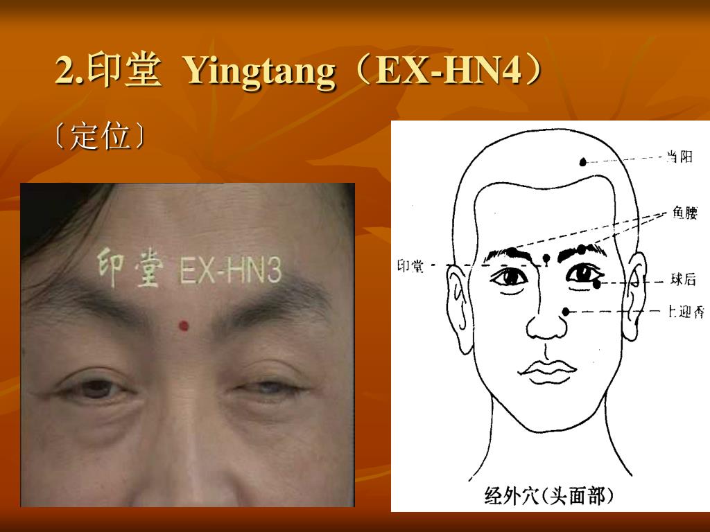 PPT - 第 四 节 常 用 奇 穴 Extra points ， EX PowerPoint Presentation - ID:3719656