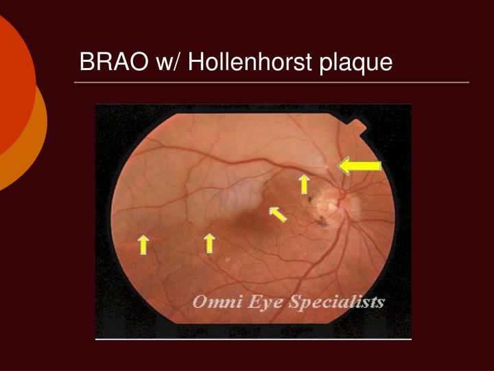 PPT - Retinal Vascular Disease PowerPoint Presentation - ID:3725188
