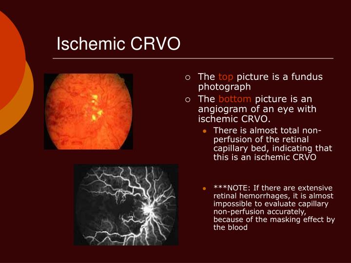 PPT - Retinal Vascular Disease PowerPoint Presentation - ID:3725188