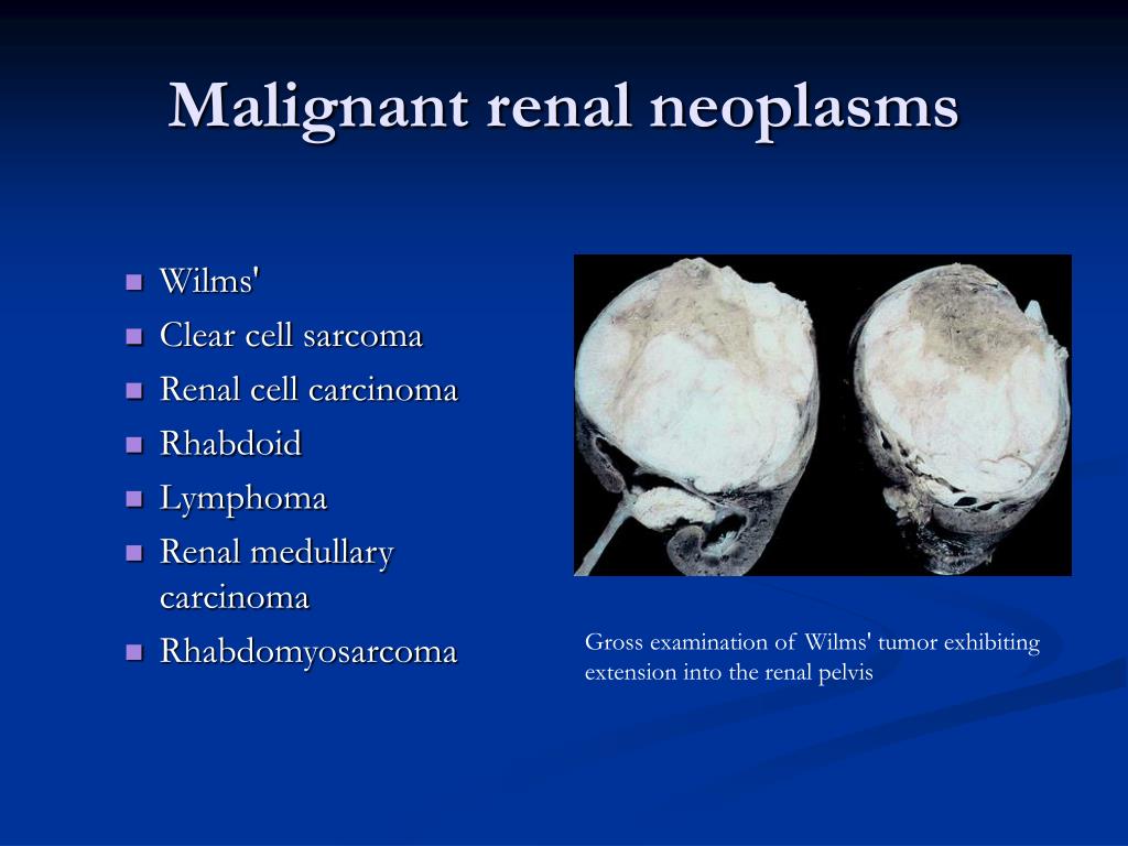 PPT - Imaging of Renal Neoplasms in Infants and Children PowerPoint ...