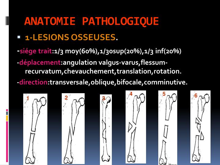 PPT - FRACTURES DE LA DIAPHYSE FEMORALE PowerPoint Presentation - ID ...
