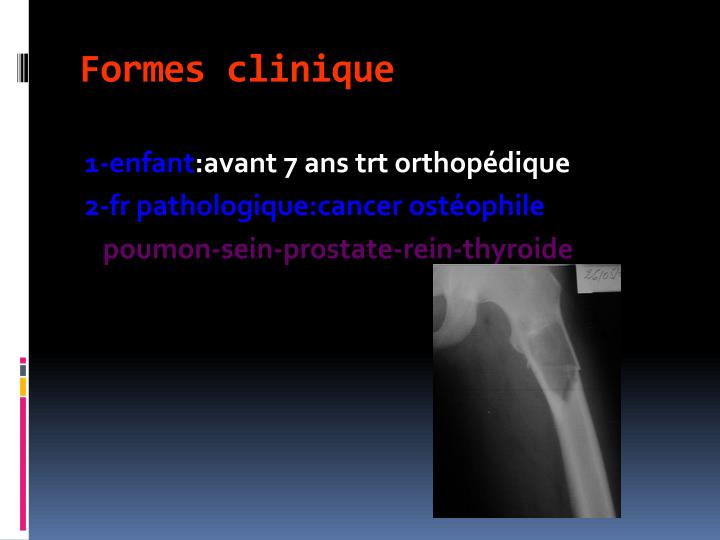PPT - FRACTURES DE LA DIAPHYSE FEMORALE PowerPoint Presentation - ID ...