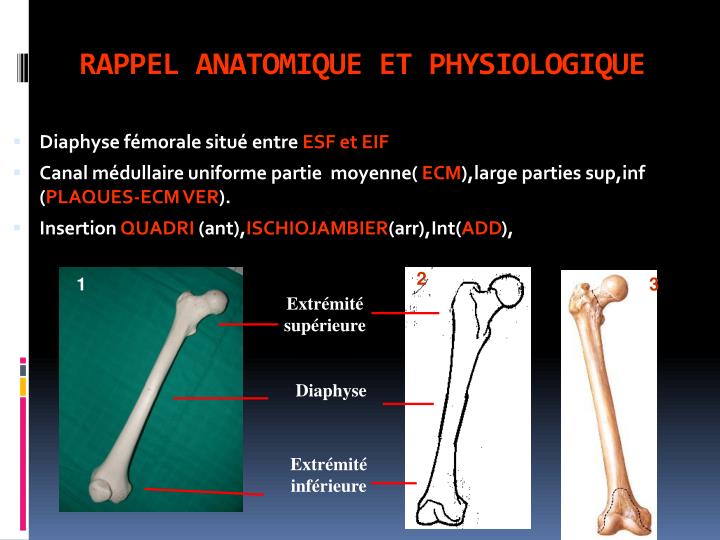 PPT - FRACTURES DE LA DIAPHYSE FEMORALE PowerPoint Presentation - ID ...