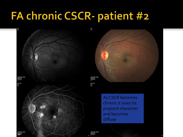 PPT - Central Serous Chorioretinopathy PowerPoint Presentation - ID:3728615