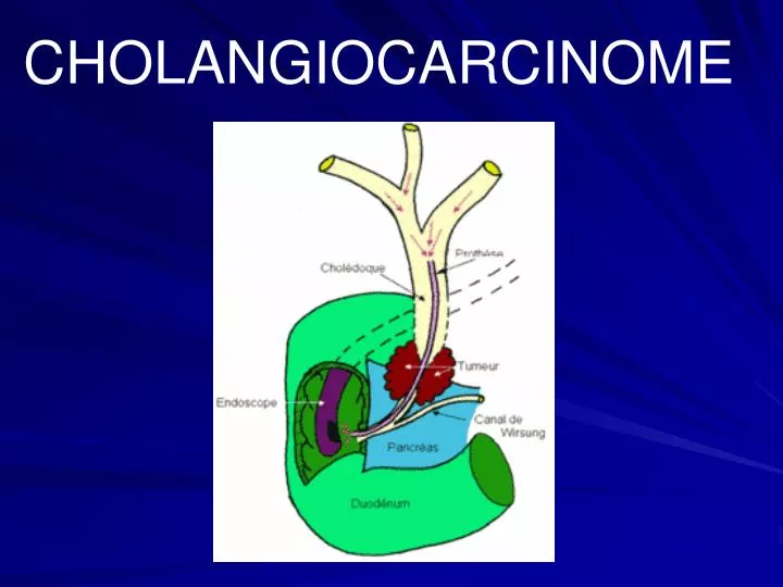 PPT - CHOLANGIOCARCINOME PowerPoint Presentation, free download - ID ...