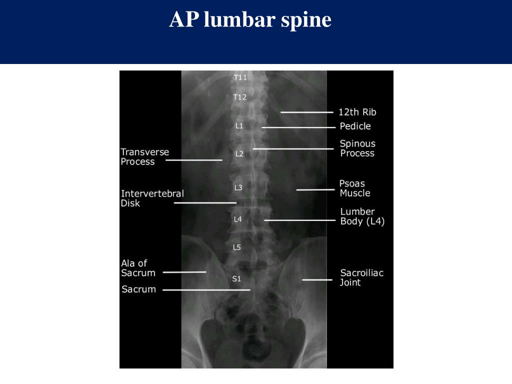 Ppt Spine Radiography Powerpoint Presentation Free Download Id 3733645