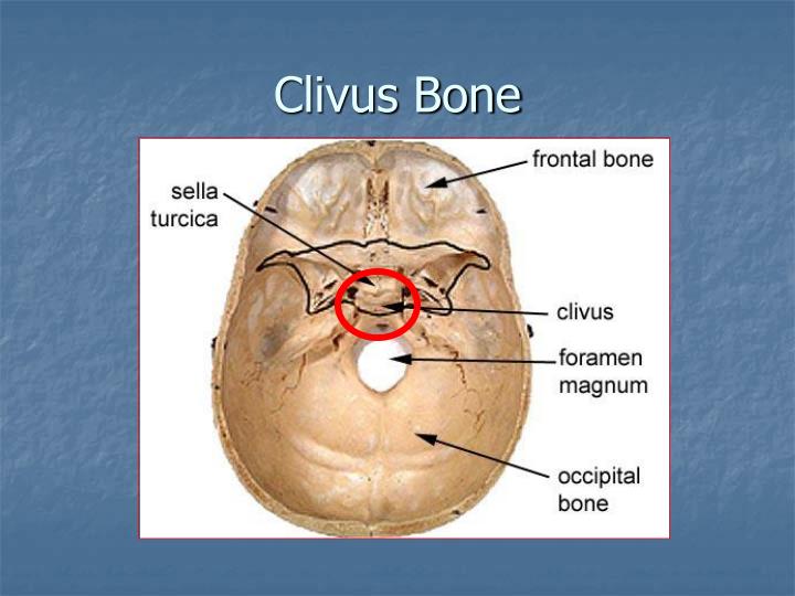 PPT - Clivus Bone Metastasis: Review of Cranial Nerves PowerPoint ...