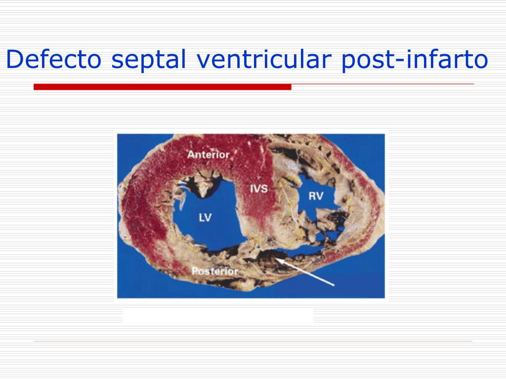 PPT - Complicaciones mecánicas del infarto agudo de miocardio ...