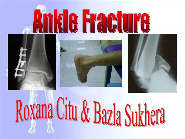 PPT - Ankle Fracture PowerPoint Presentation, free download - ID:3744012