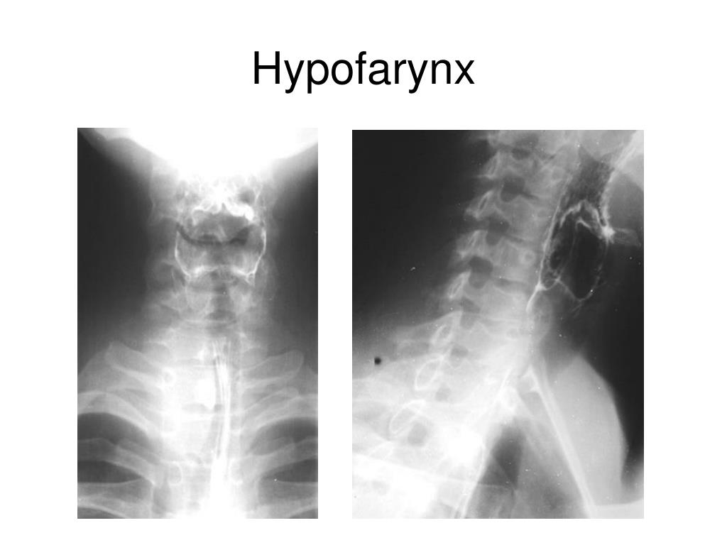 PPT - Radiodiagnostika trávicí trubice PowerPoint Presentation, free ...