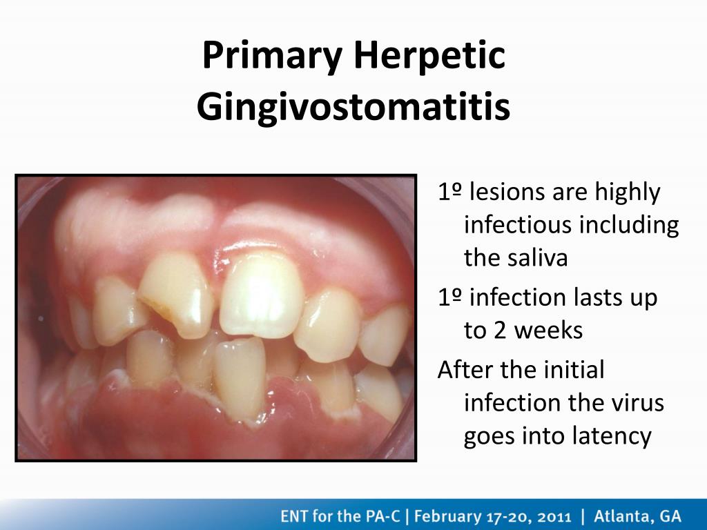 PPT - Differential Diagnoses and Treatment of Oral Lesions PowerPoint ...