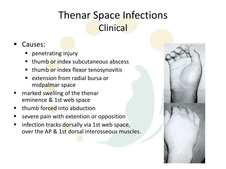 PPT - Hand Infections PowerPoint Presentation - ID:3753697