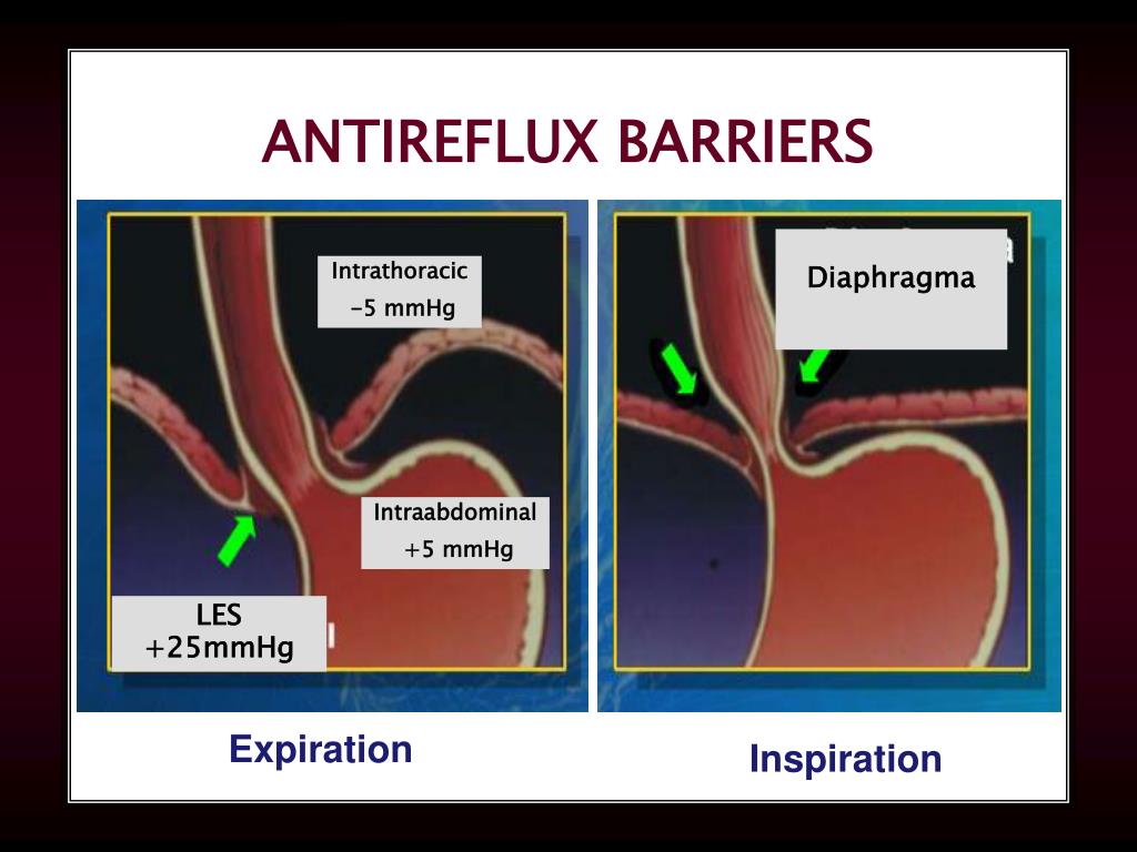 PPT - GASTROESOPHAGEAL REFLUX DISEASES PowerPoint Presentation, free ...