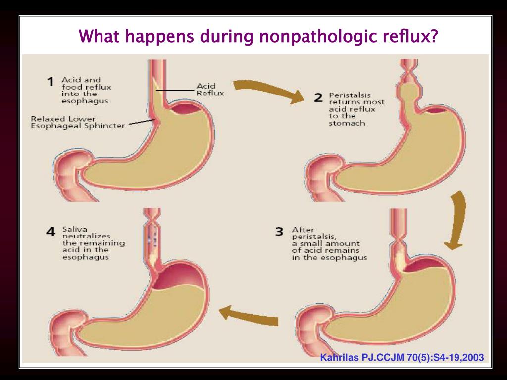 PPT - GASTROESOPHAGEAL REFLUX DISEASES PowerPoint Presentation, free ...