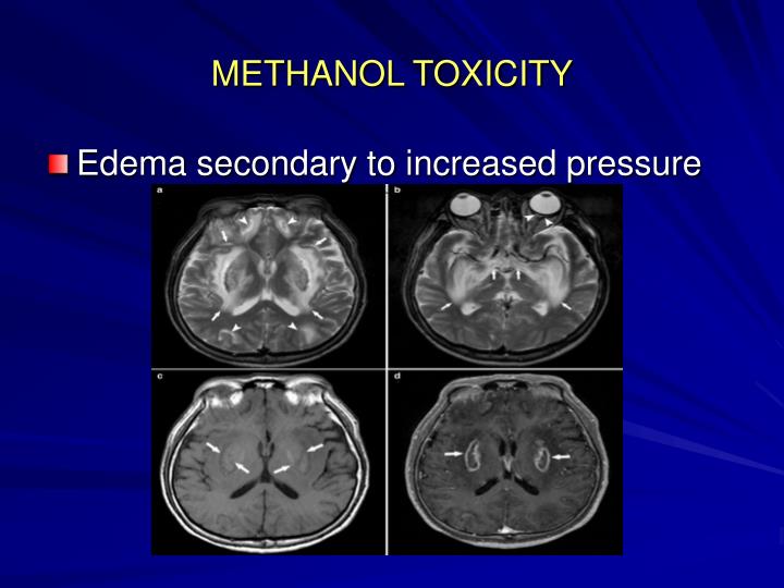 PPT - ADDICTION AND VISION LOSS PowerPoint Presentation - ID:3756187