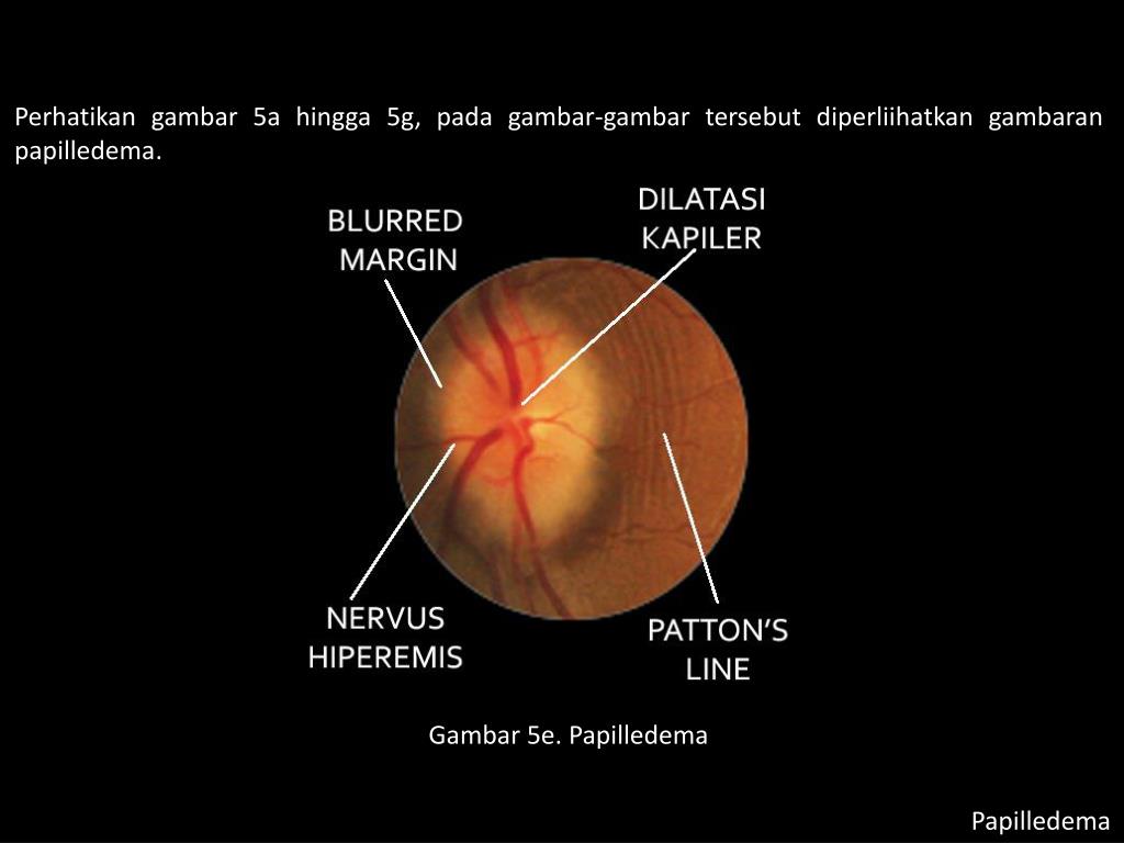 PPT - Papilledema PowerPoint Presentation, free download - ID:3760992
