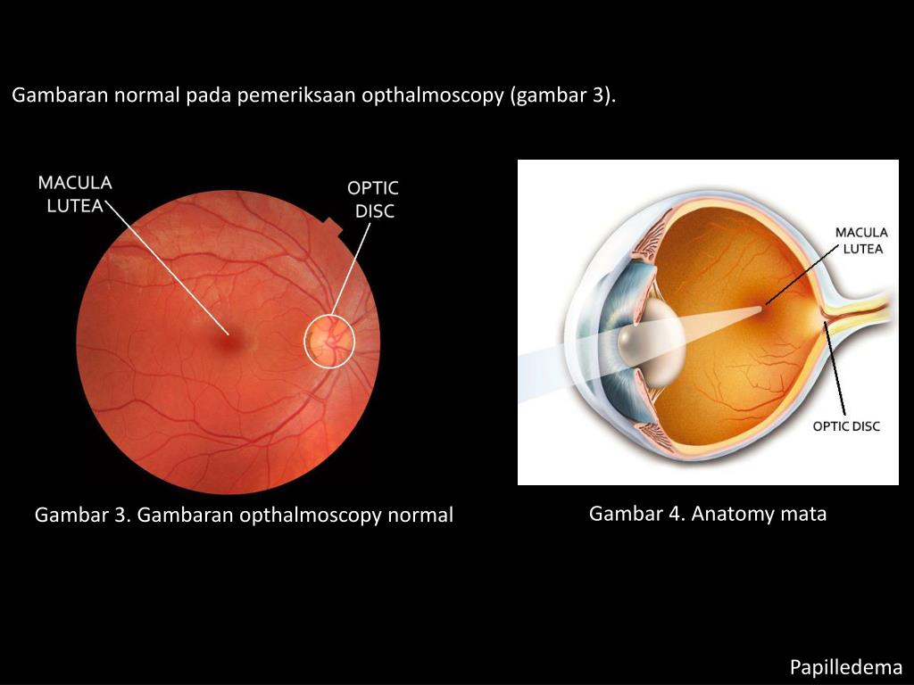 PPT - Papilledema PowerPoint Presentation, free download - ID:3760992