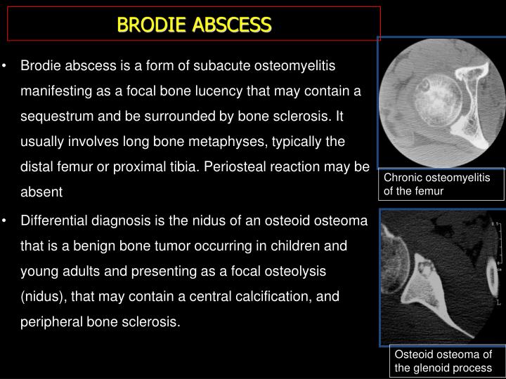 PPT - BONE INFECTION MIMICKING BONE TUMORS: HOW TO MAKE THE DISTINCTION ...