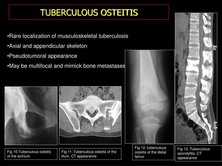 PPT - BONE INFECTION MIMICKING BONE TUMORS: HOW TO MAKE THE DISTINCTION ...