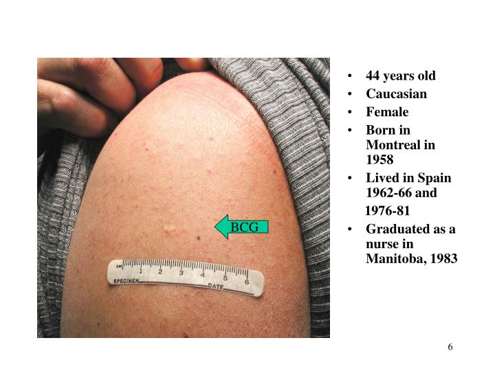 PPT - Recognition of BCG Scars PowerPoint Presentation - ID:3764793