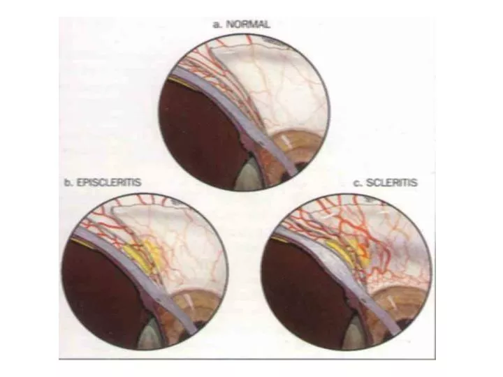 PPT - EPISCLERITIS is a benign, self limiting and recurrent disorder of ...