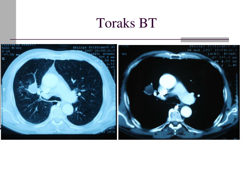 PPT - Doç Dr Sevin Başer Öncel Pamukkale Üniversitesi Göğüs ...