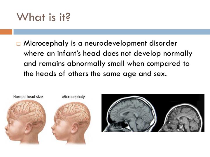 PPT - MICROCEPHALY PowerPoint Presentation - ID:3780061