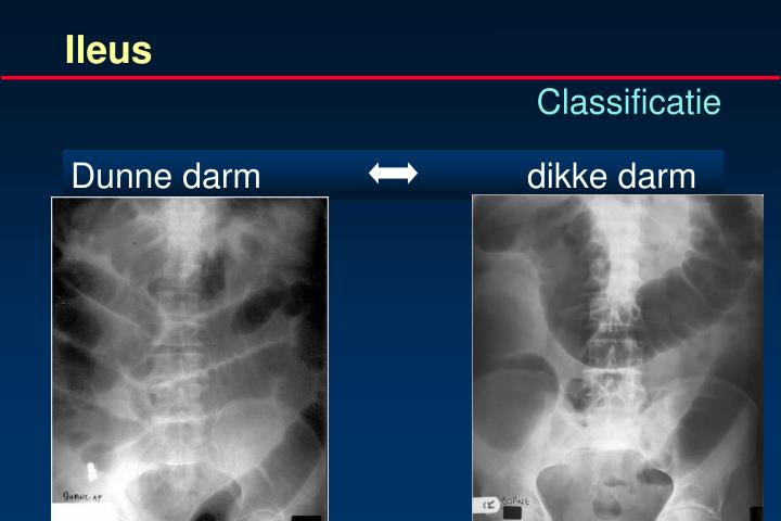 PPT - Radiodiagnostiek bij ileus PowerPoint Presentation - ID:3783342