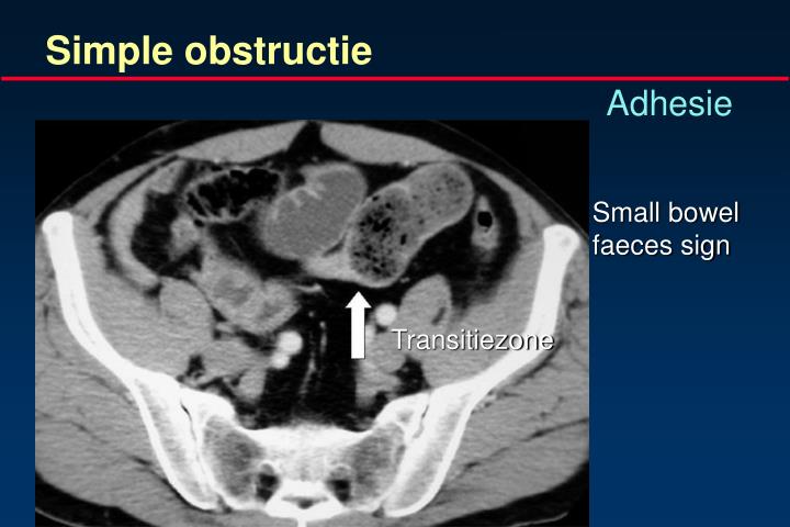 PPT - Radiodiagnostiek bij ileus PowerPoint Presentation - ID:3783342