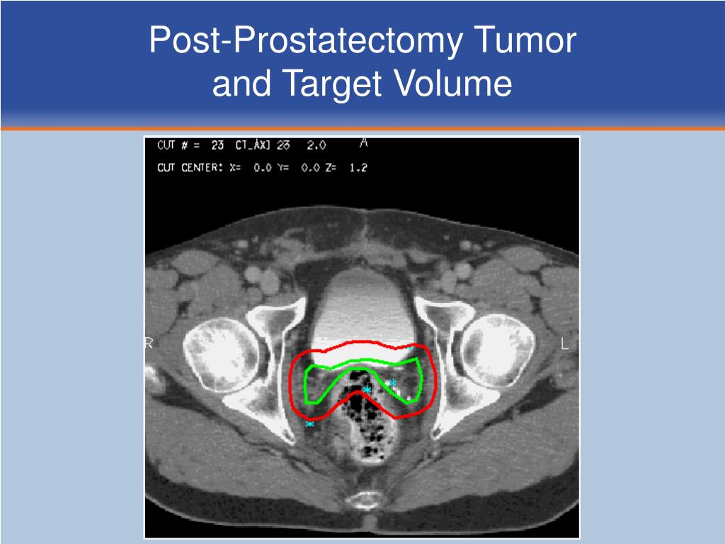 PPT - Howard M. Sandler, MD University of Michigan Medical School ...