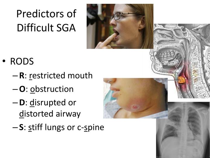 PPT - #3 Intro to EM Airway Management- Assessment and SupraGlottic ...