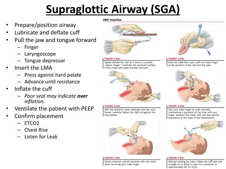 PPT - #3 Intro to EM Airway Management- Assessment and SupraGlottic ...