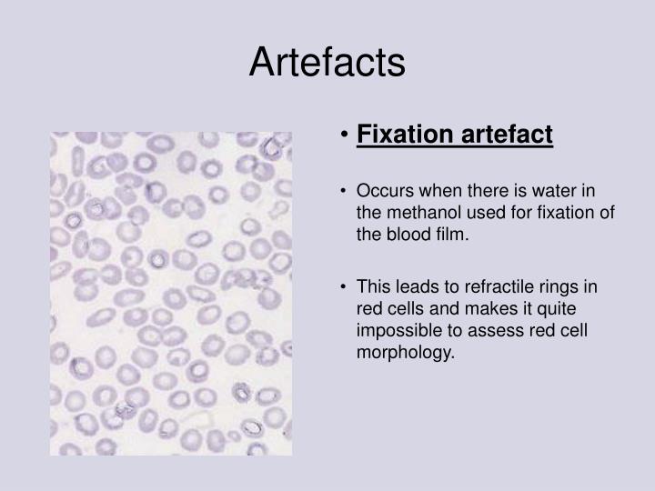 PPT - Romanowsky stains and Artefacts in blood films PowerPoint ...