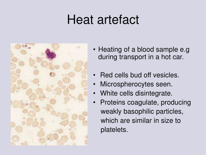 PPT - Romanowsky stains and Artefacts in blood films PowerPoint ...