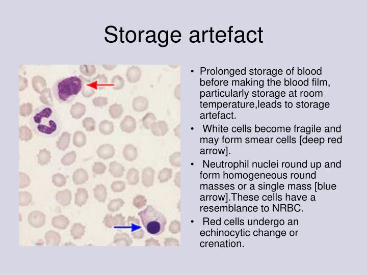 PPT - Romanowsky stains and Artefacts in blood films PowerPoint ...