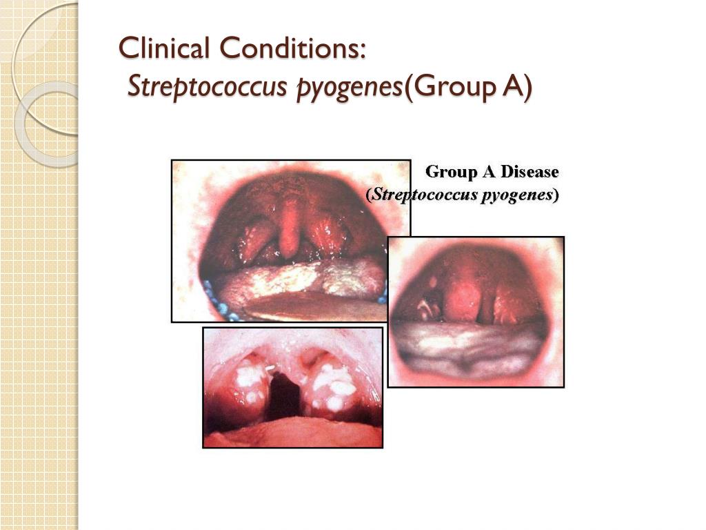 Streptococcus Pyogenes Diseases