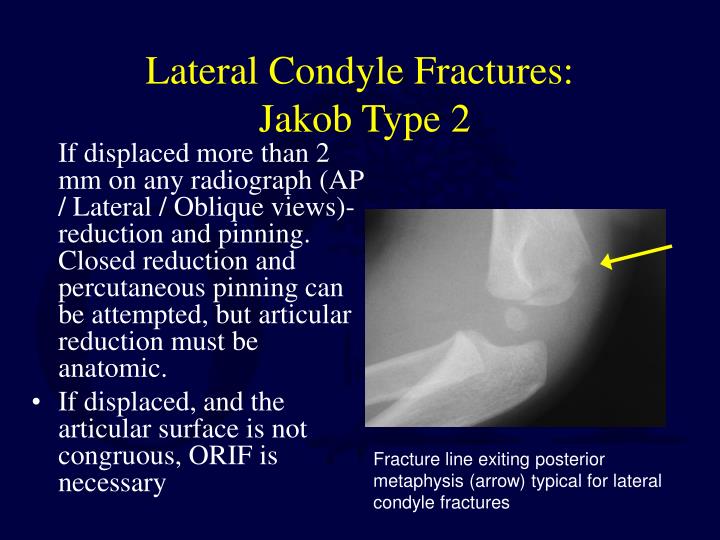 PPT - Fractures and Dislocations about the Elbow in the Pediatric ...
