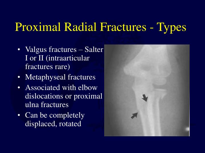 PPT - Fractures and Dislocations about the Elbow in the Pediatric ...