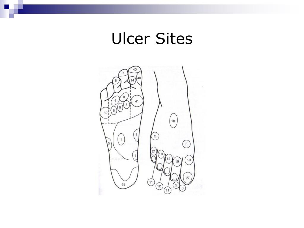 PPT - Orthotic Treatment of The Neuropathic Diabetic Foot PowerPoint ...