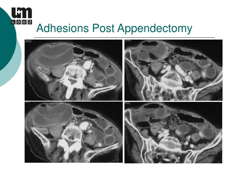 PPT - Intestinal obstruction PowerPoint Presentation - ID:3823076