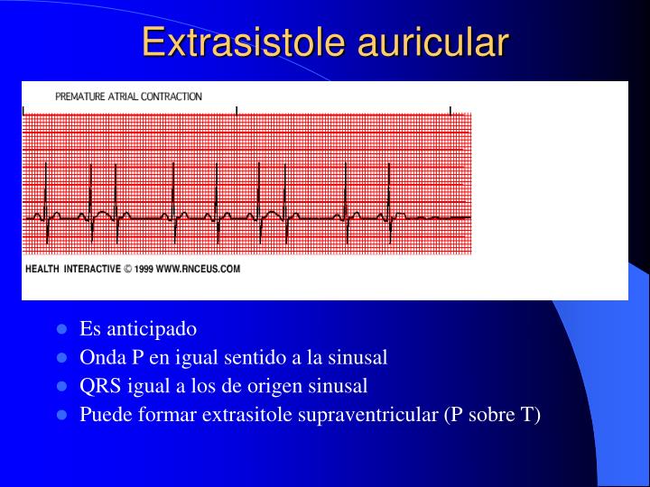 PPT - ARRITMIAS CARDIACAS PowerPoint Presentation - ID:3824403