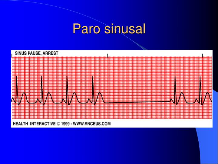 PPT - ARRITMIAS CARDIACAS PowerPoint Presentation - ID:3824403