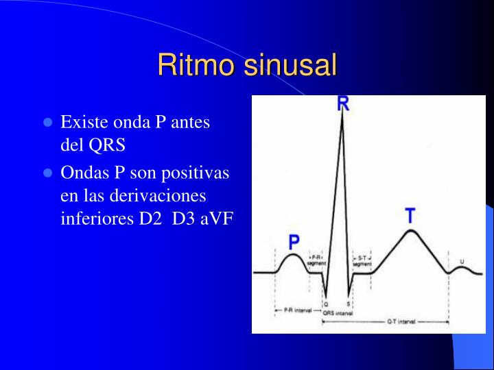 PPT - ARRITMIAS CARDIACAS PowerPoint Presentation - ID:3824403